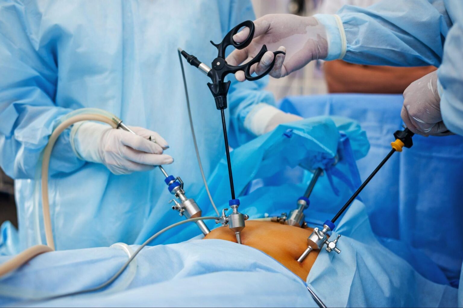 What is Laparoscopic Cholecystectomy: Procedure, Risks and Recovery ...